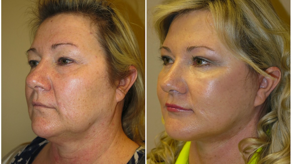 Look Younger with New Facial Procedure - Studio 5